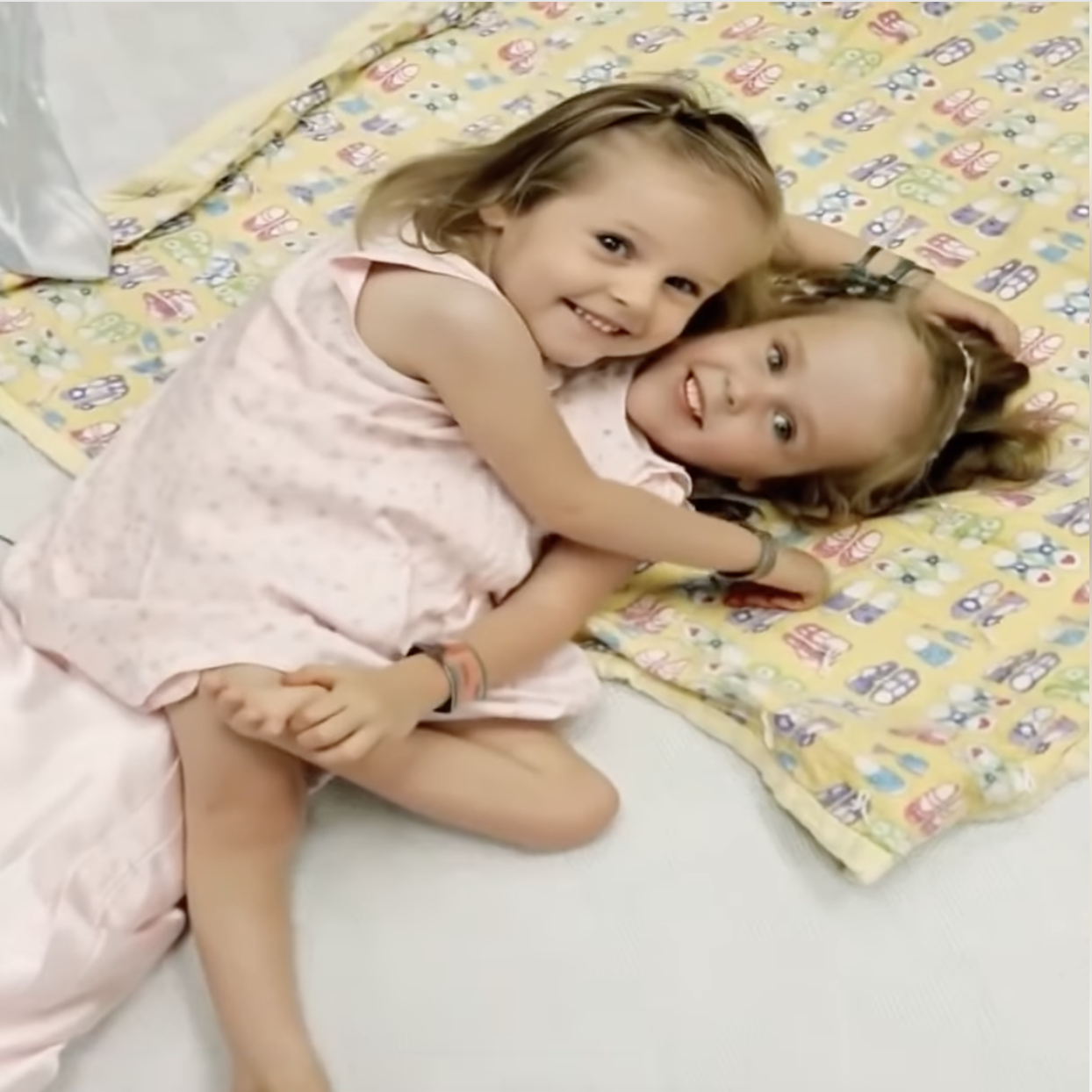 Unbelievable story ️ ️ These girls were born as siamese twins, but were ...